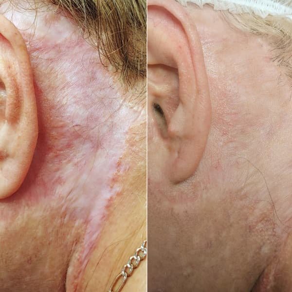 Tattoo-Narben: Kann man eine Narbe mit einem Tattoo überdecken? | VeAn ...