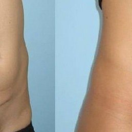 Tattoo-Narben: Kann man eine Narbe mit einem Tattoo überdecken? | VeAn ...