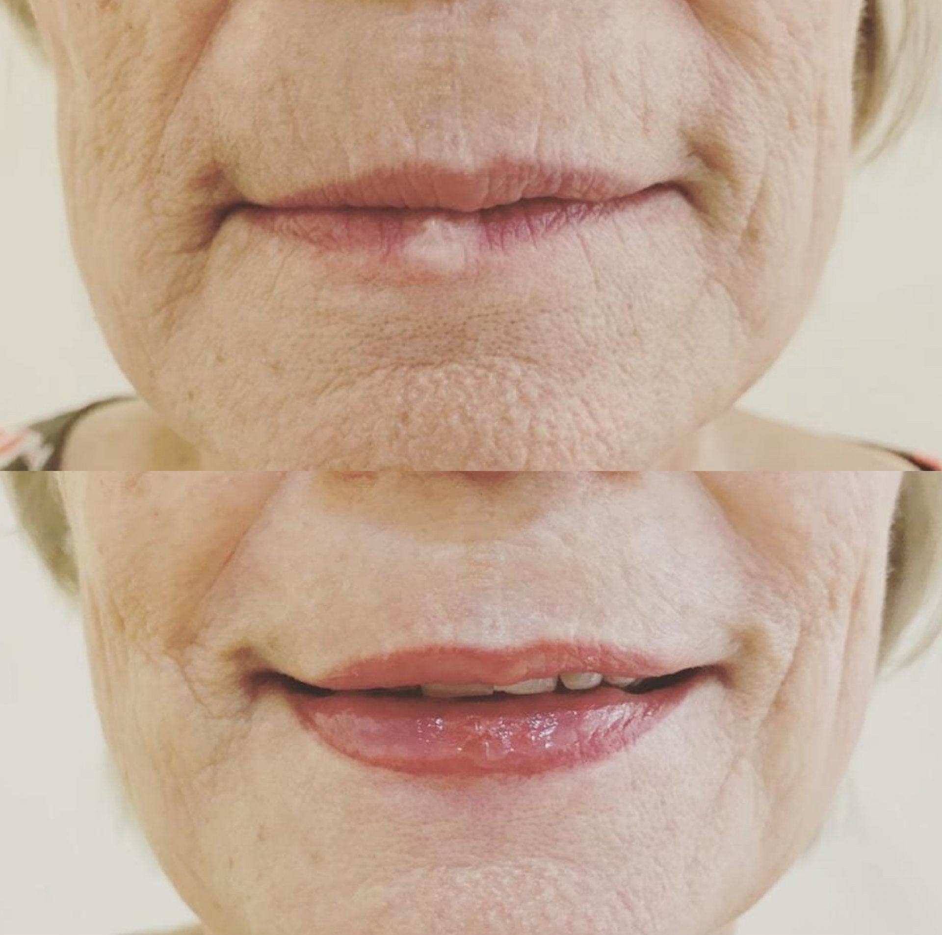 Tattoo-Narben: Kann man eine Narbe mit einem Tattoo überdecken? | VeAn ...