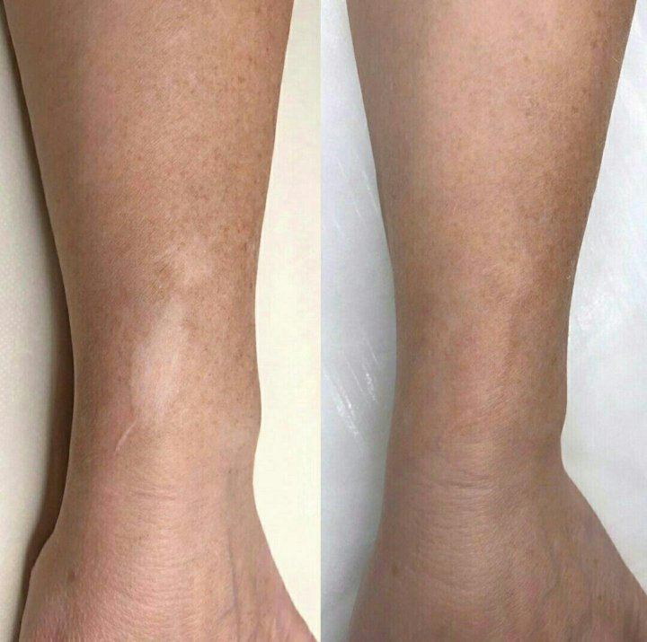 Tattoo-Narben: Kann man eine Narbe mit einem Tattoo überdecken? | VeAn ...