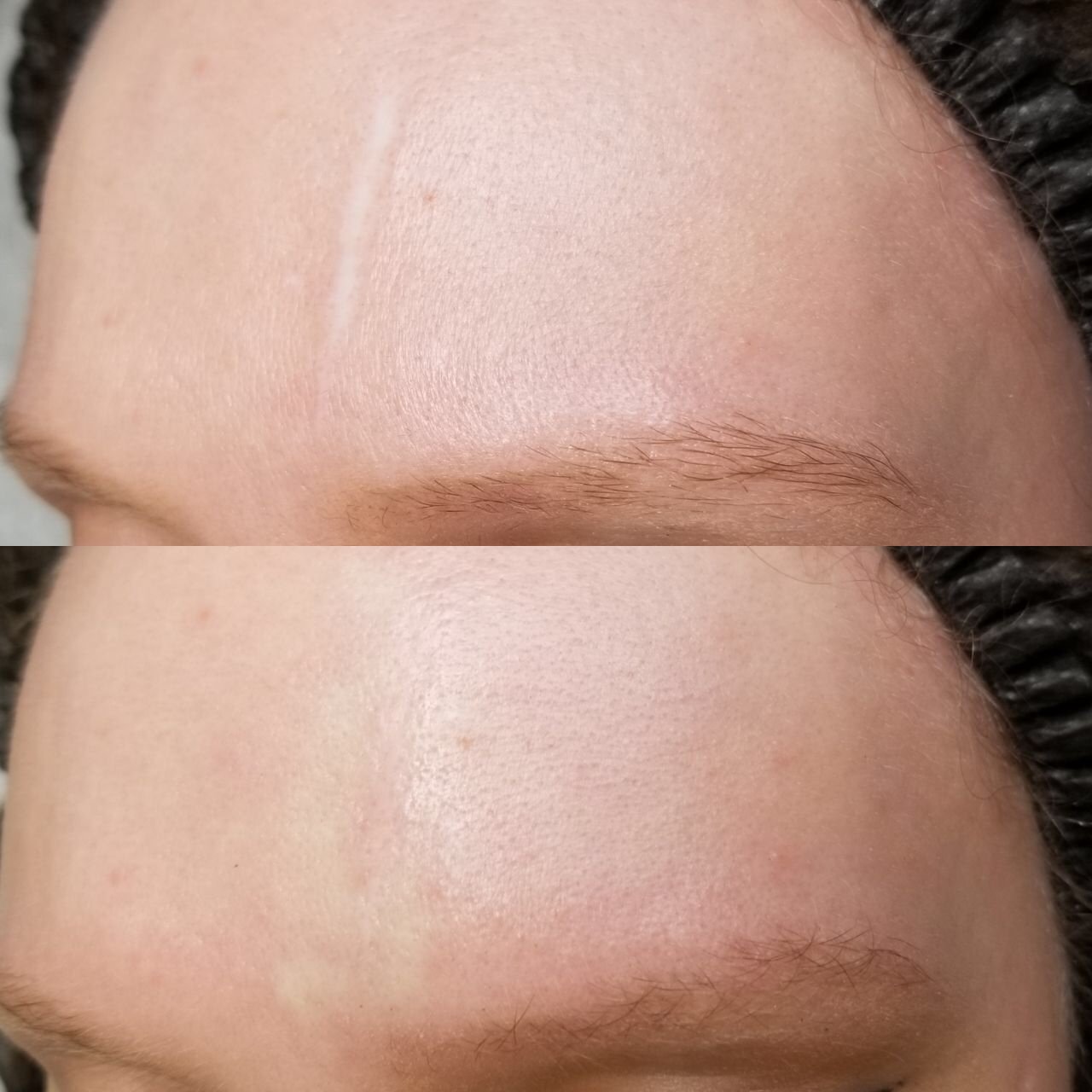 Tattoo-Narben: Kann man eine Narbe mit einem Tattoo überdecken? | VeAn ...