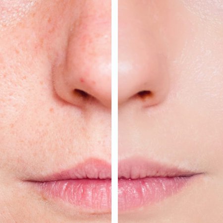 Tattoo-Narben: Kann man eine Narbe mit einem Tattoo überdecken? | VeAn ...