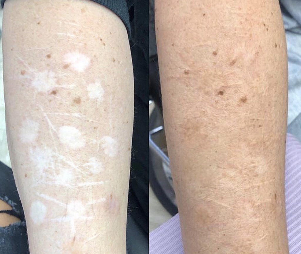 Tattoo-Narben: Kann man eine Narbe mit einem Tattoo überdecken? | VeAn ...