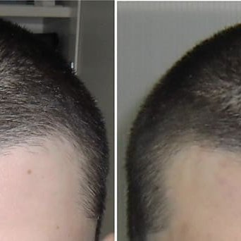 Tattoo-Narben: Kann man eine Narbe mit einem Tattoo überdecken? | VeAn ...