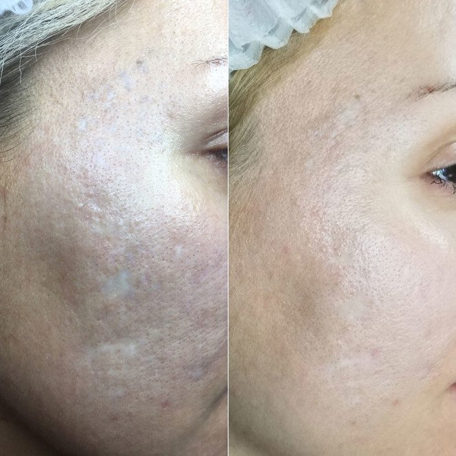 Tattoo-Narben: Kann man eine Narbe mit einem Tattoo überdecken? | VeAn ...