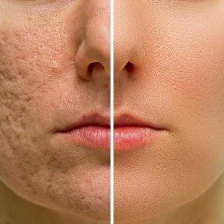 Tattoo-Narben: Kann man eine Narbe mit einem Tattoo überdecken? | VeAn ...