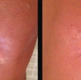 Tattoo-Narben: Kann man eine Narbe mit einem Tattoo überdecken? | VeAn ...