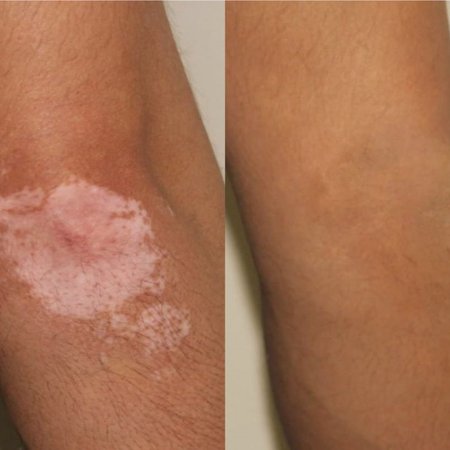 Tattoo-Narben: Kann man eine Narbe mit einem Tattoo überdecken? | VeAn ...