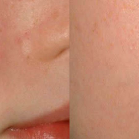 Tattoo-Narben: Kann man eine Narbe mit einem Tattoo überdecken? | VeAn ...