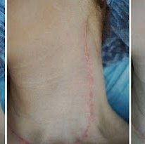 Tattoo-Narben: Kann man eine Narbe mit einem Tattoo überdecken? | VeAn ...