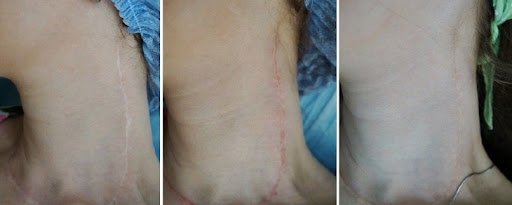 Tattoo-Narben: Kann man eine Narbe mit einem Tattoo überdecken? | VeAn ...